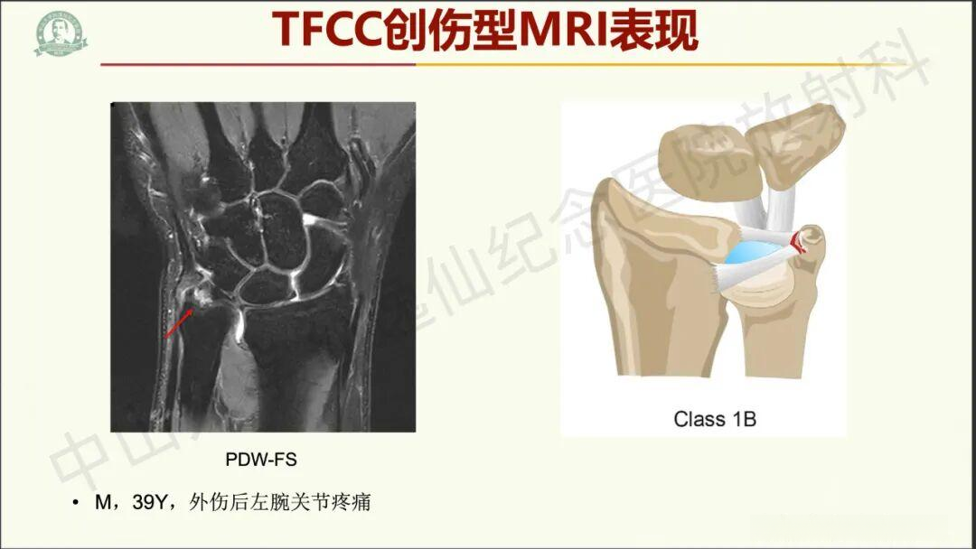TFCC损伤MRI诊断 - 知乎