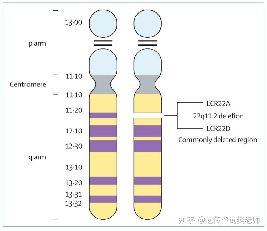 【22q11综合征】22q11微缺失综合征与22q11微重复综合征 - 知乎