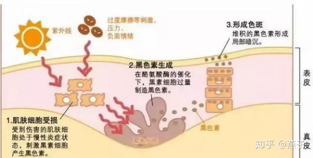 要祛斑,这些色斑面诊原理你要懂! 知乎