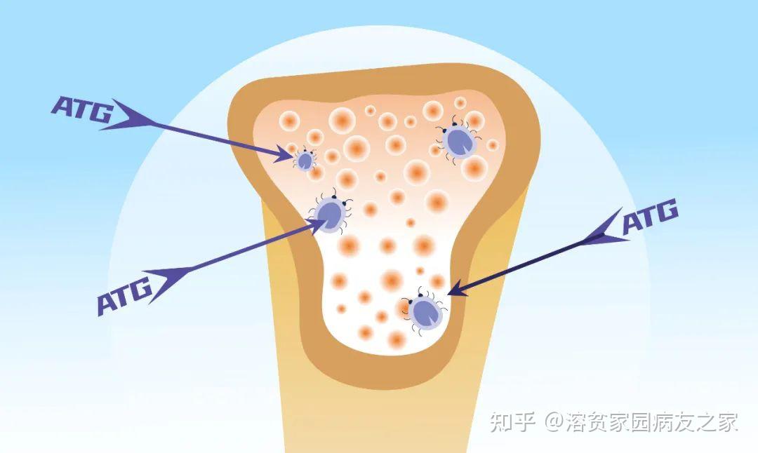 移植决策丨ATG是一种什么药物？重型再生障碍性贫血一定要用ATG治疗吗？ - 知乎
