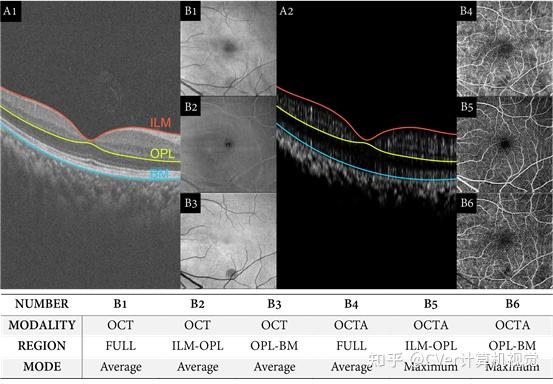 80GB 医学影像数据集发布！OCTA-500公开下载 - 知乎