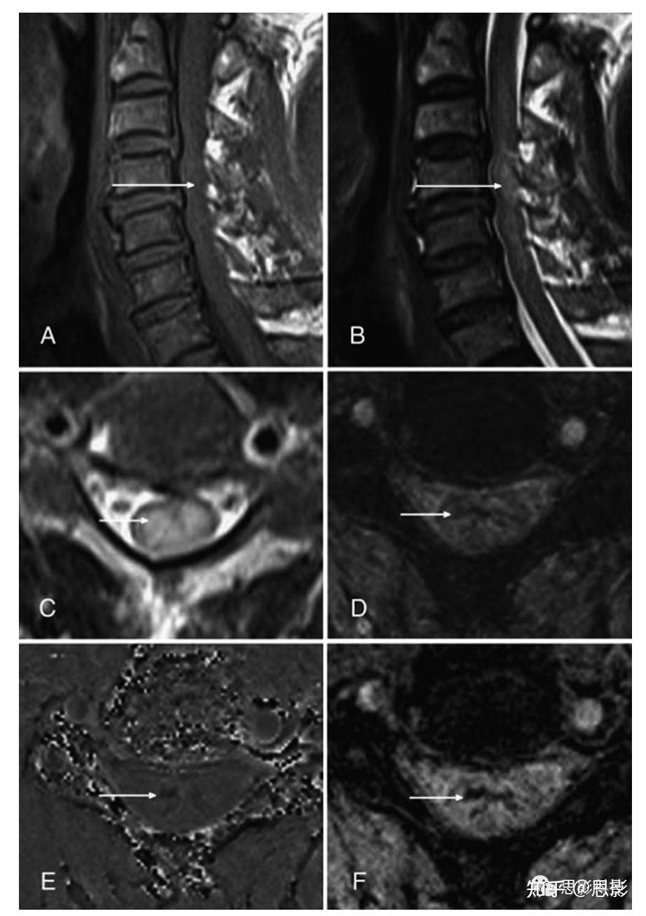 磁敏感加权成像（SWI)：技术要点和临床神经学应用 - 知乎