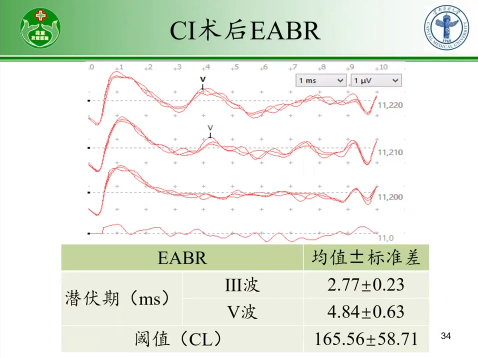 临床听力学技术专业沙龙｜人工耳蜗植入术中及术后EABR的应用 - 知乎
