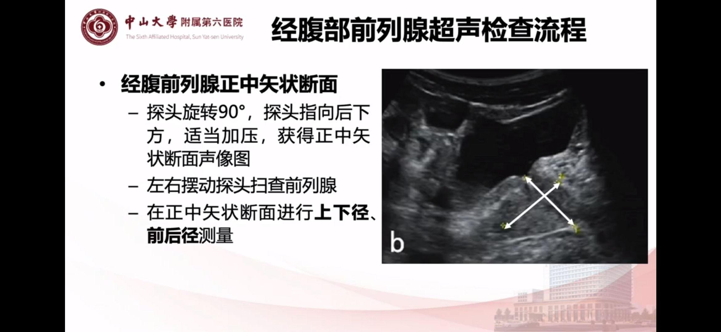 经腹部前列腺超声及残余尿测定检查流程 知乎