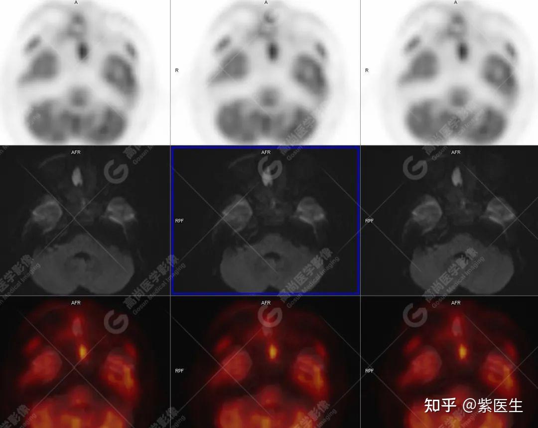 【高尚医学影像病例】PET-CT/MR增强多模态诊断结外NK/T细胞淋巴瘤复发一例 - 知乎