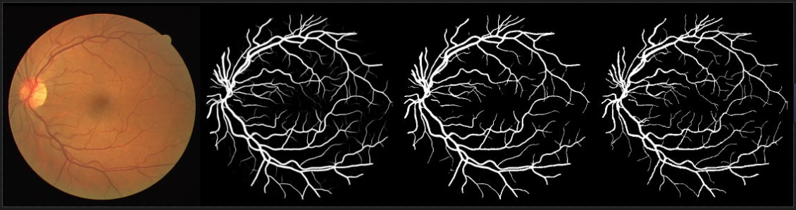 视网膜血管分割代码(Pytorch实现) - 知乎