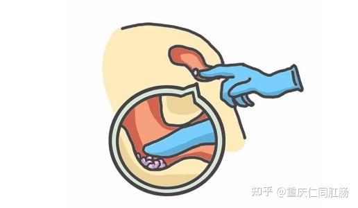重庆医院肛门医院不能忽视的检查：肛门指检 知乎