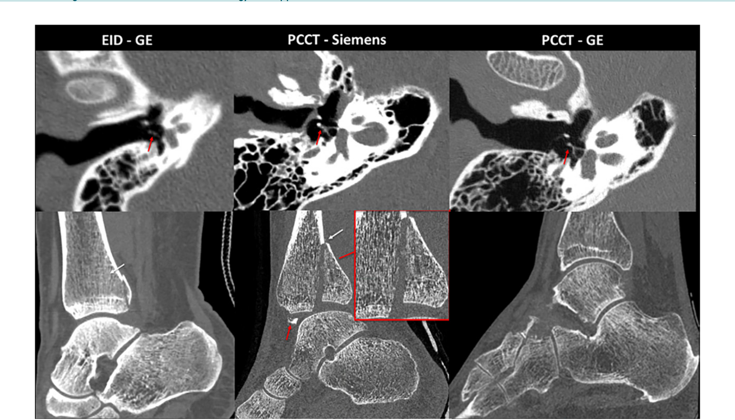 CT技术革命？一文读懂光子计数CT（PCCT）的前沿进展与临床潜力 - 知乎