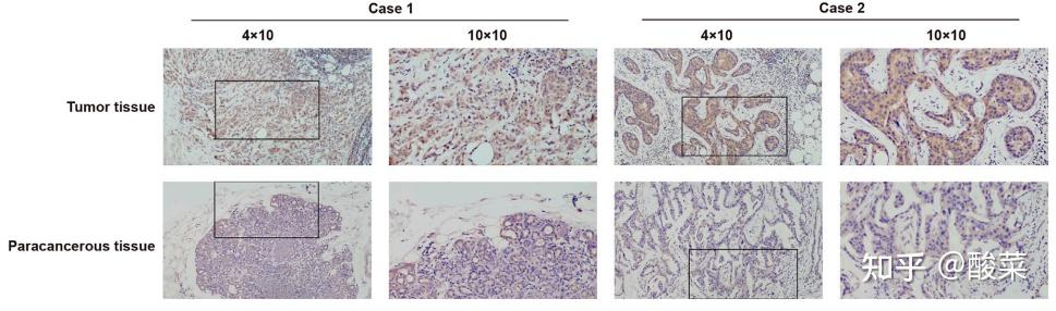 仙桃学术 | 仙桃风单基因乳腺癌MCTS1 - 知乎