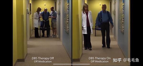 美敦力Percept PC脑起搏器治疗帕金森 - 知乎