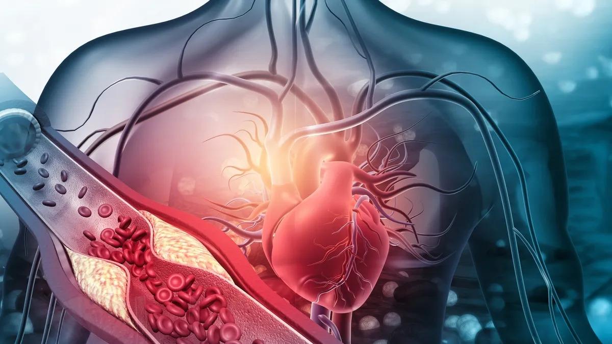礼来siRNA药物Lepodisiran，一剂可降脂蛋白(a)高达94%、持续48周 - 知乎