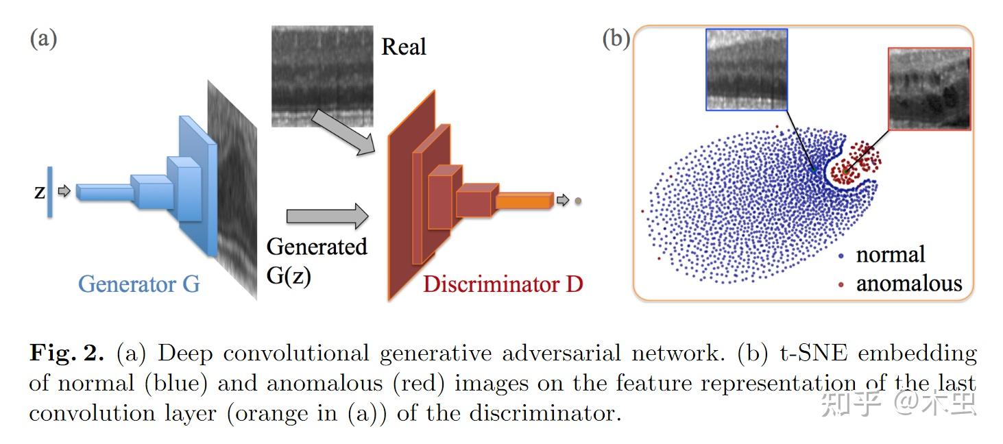 Unsupervised Anomaly Detection with Generative Adversarial Networks to ...