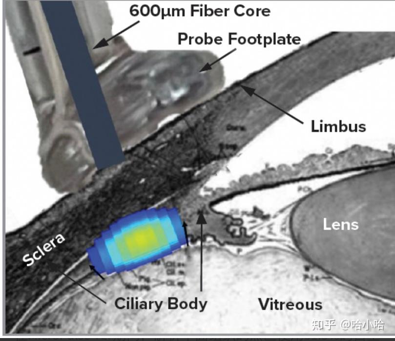 带你了解MicroPulse®跨巩膜激光治疗青光眼：国际德尔福小组的指南 - 知乎