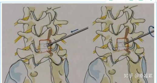 UBE 这些差别你知道吗？PLF PLIF TLIF DLIF XLIF 手术技术对比【医术苑】科普 - 知乎