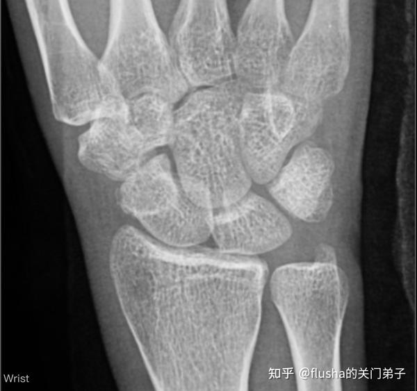 右手手腕舟骨骨折恢复过程 - 知乎