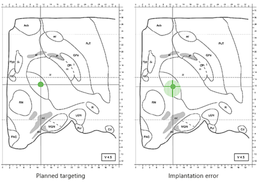 DBS术中如何确认电极位置？ - 知乎