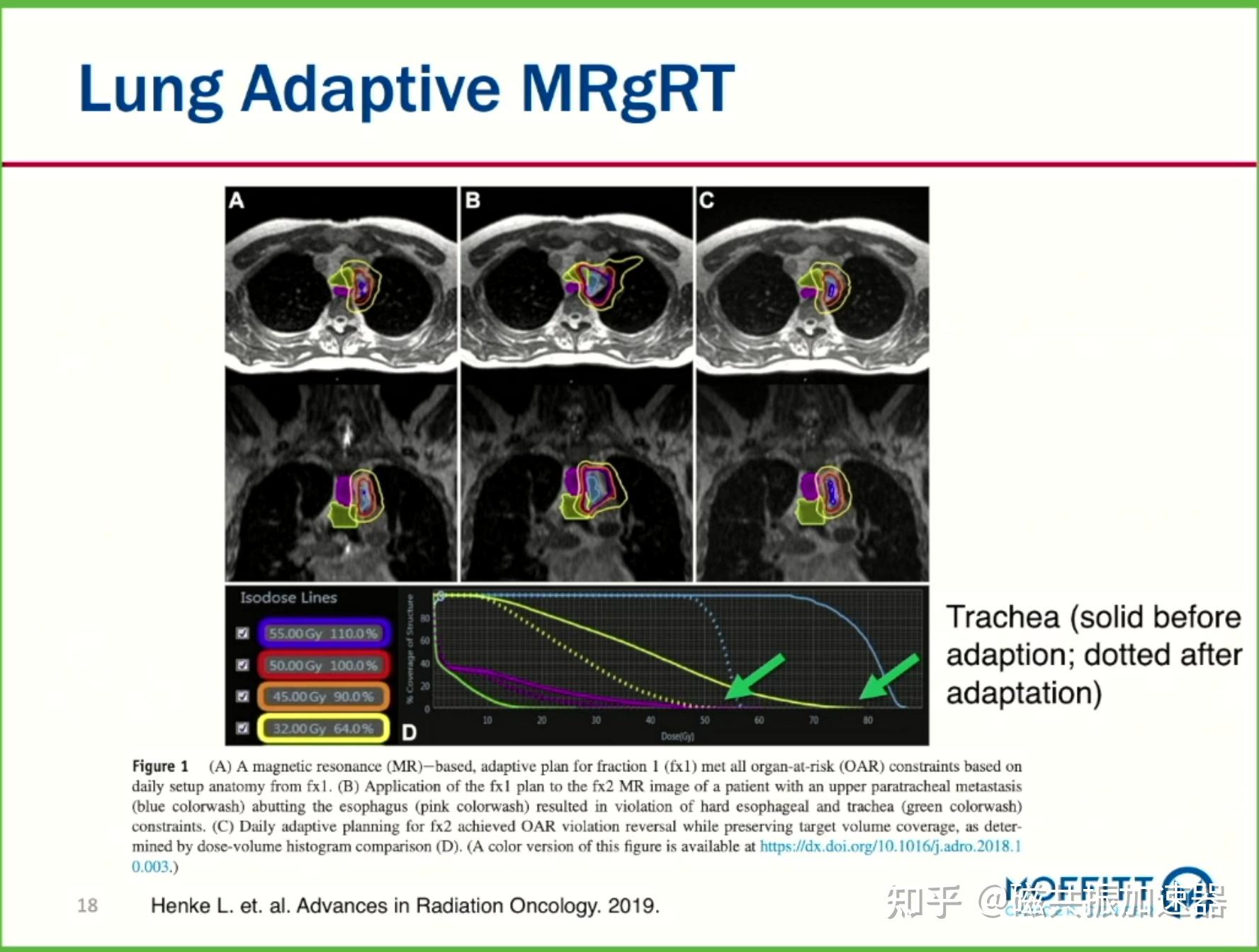 “穿针引线”-磁共振引导的中央、超中央型肺癌放射消融治疗 - ViewRay MRIdian - 知乎