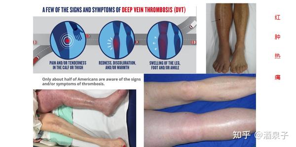 VTE、DVT与PE的关系 - 知乎
