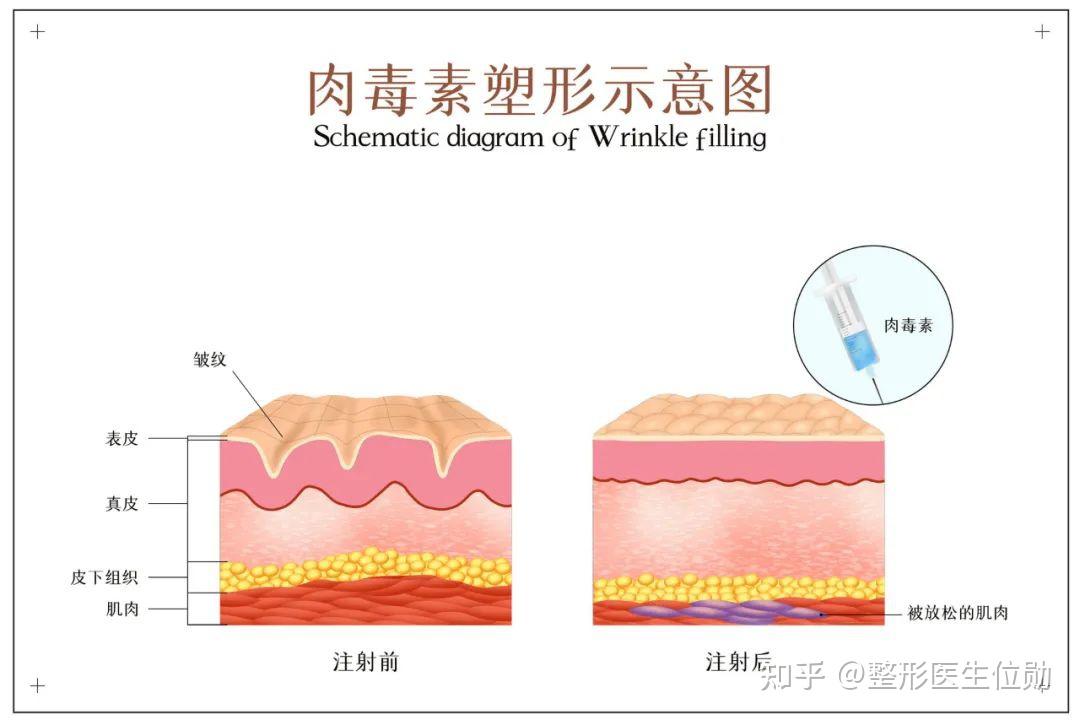 祛皱，你知道你的皱纹类型吗？ - 知乎