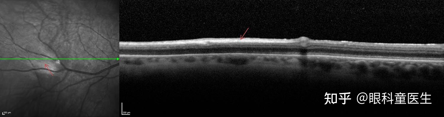 视网膜先天性异常——2、视网膜有髓神经纤维 - 知乎