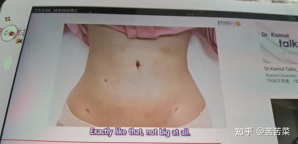 mtf 跨性别 srs ppv（腹膜） log - 知乎