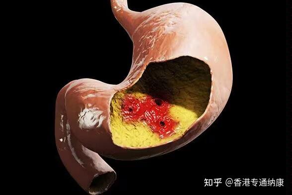 德喜曲妥珠单抗DS-8201(ENHERTU)胃癌或胃食管结合部癌临床数据 - 知乎