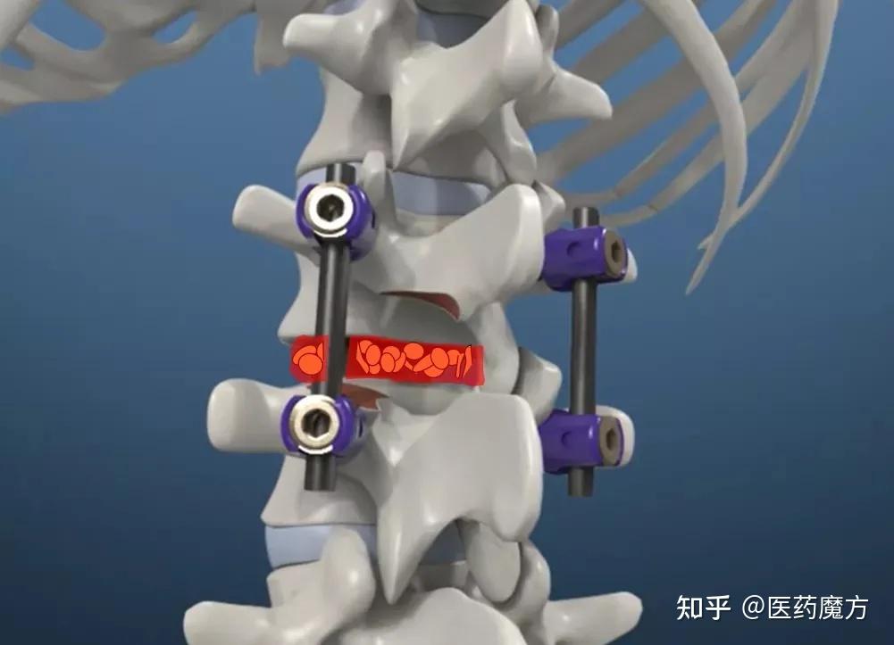 柯华珠访谈 | 循药物研发之本，做骨关节疾病创新药“开拓者” - 知乎