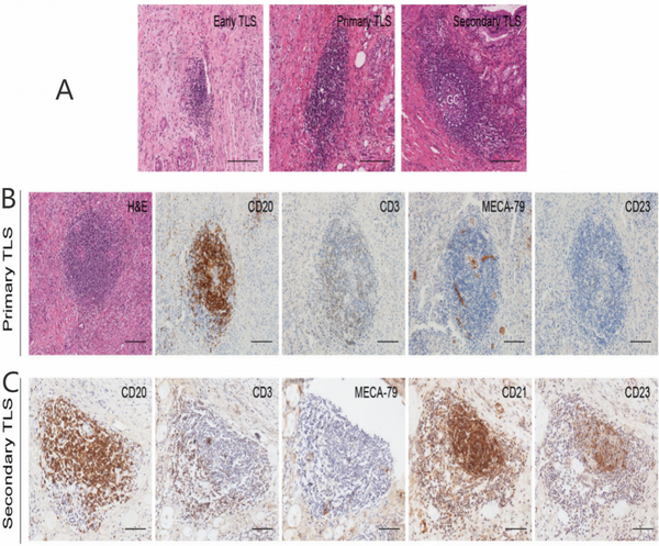 三级淋巴结构在肿瘤微环境中的作用 - 知乎