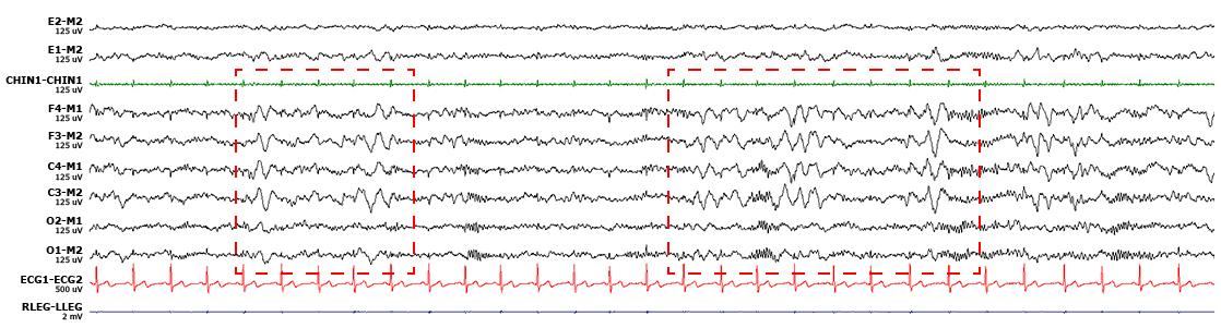 正常睡眠的分期和结构 - 知乎