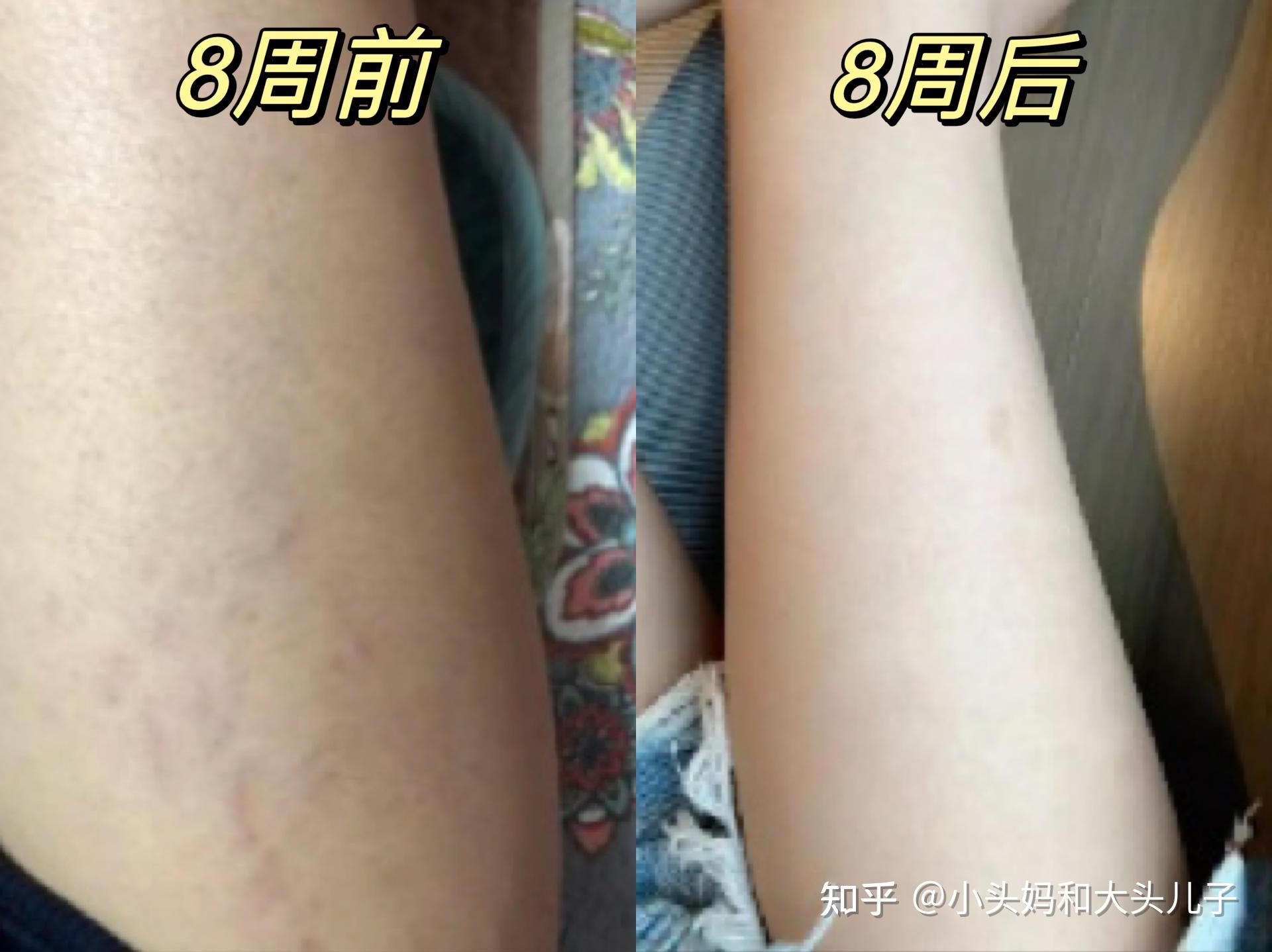 肥胖纹能够淡化吗？减肥后居然长了肥胖纹？通过老爸抽检的淡纹产品居然这么好用！历经2个月，我的肥胖纹终于淡化了！！！
