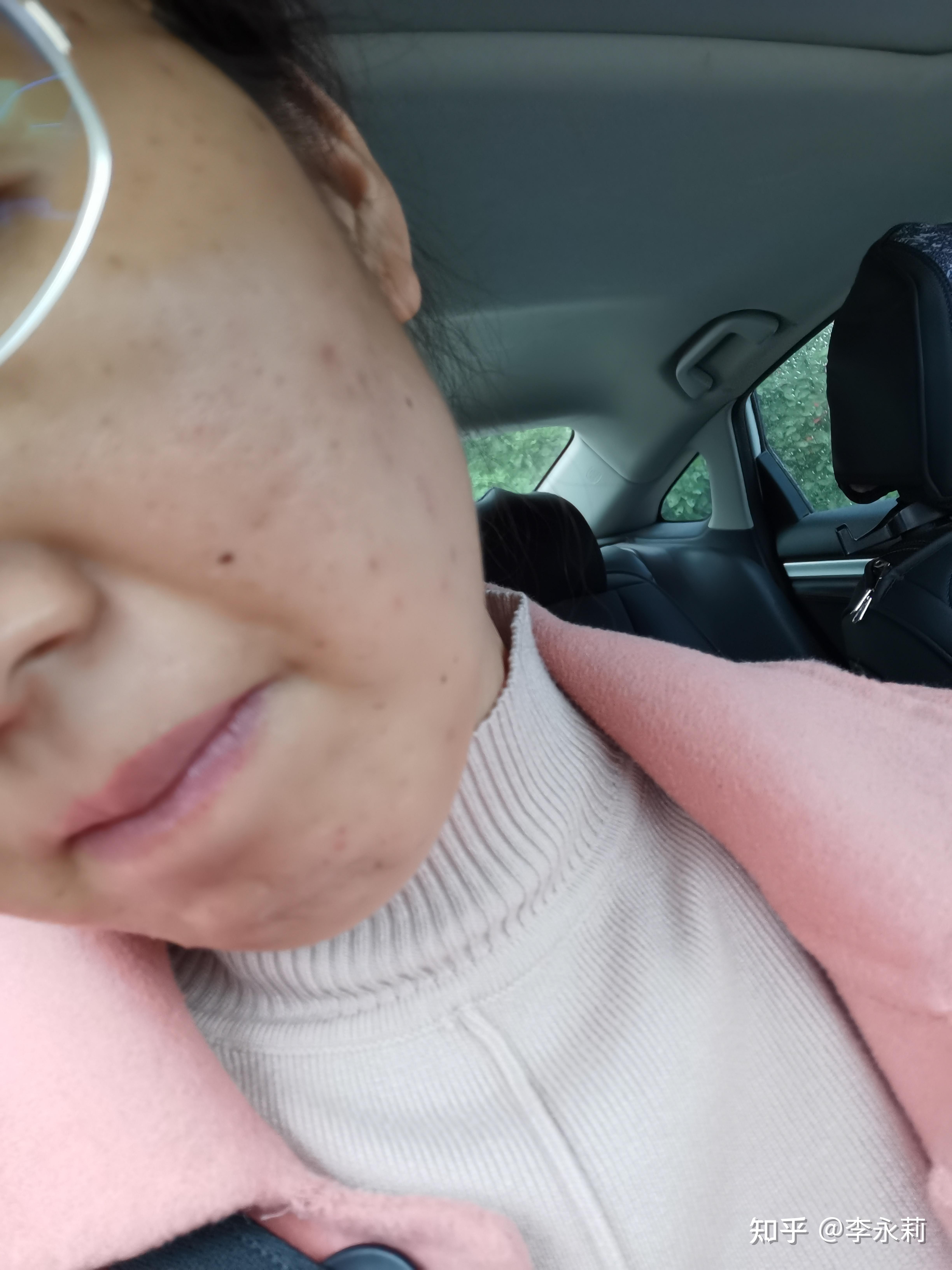 西药战痘第11天 - 知乎