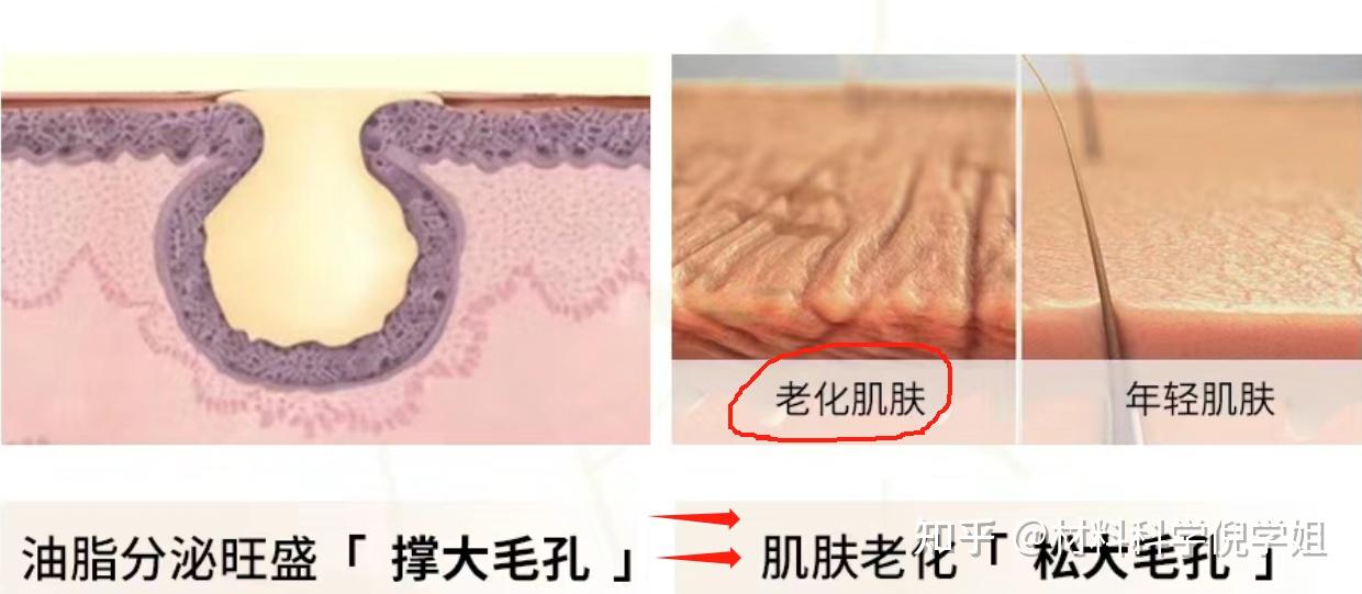 鼻子被黑头爬满,密密麻麻的黑头巨丑,影响颜值,问下黑头怎么去掉啊?【专业配方师】教你去黑头最有效的方法,去除各种难搞黑头,还你妈生好皮肤,效果贼猛! 知乎
