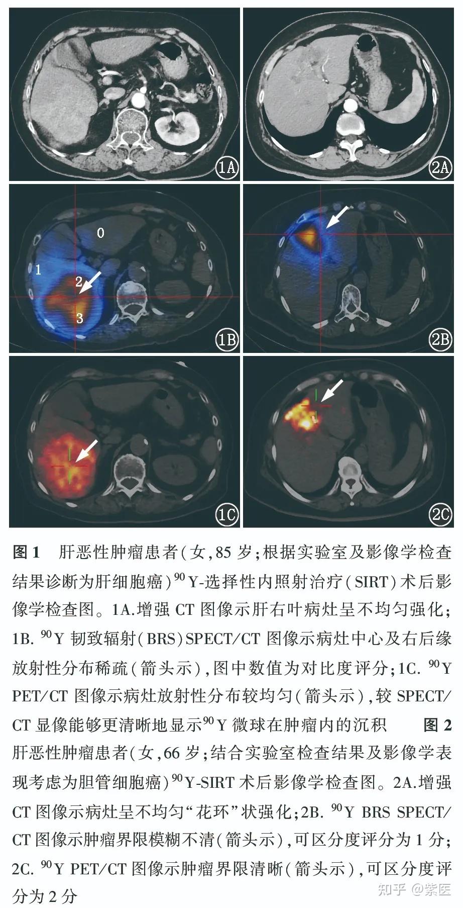 90Y PET/CT和90Y韧致辐射SPECT/CT显像评估肝恶性肿瘤90Y-选择性内放射治疗后辐射剂量的对比 - 知乎