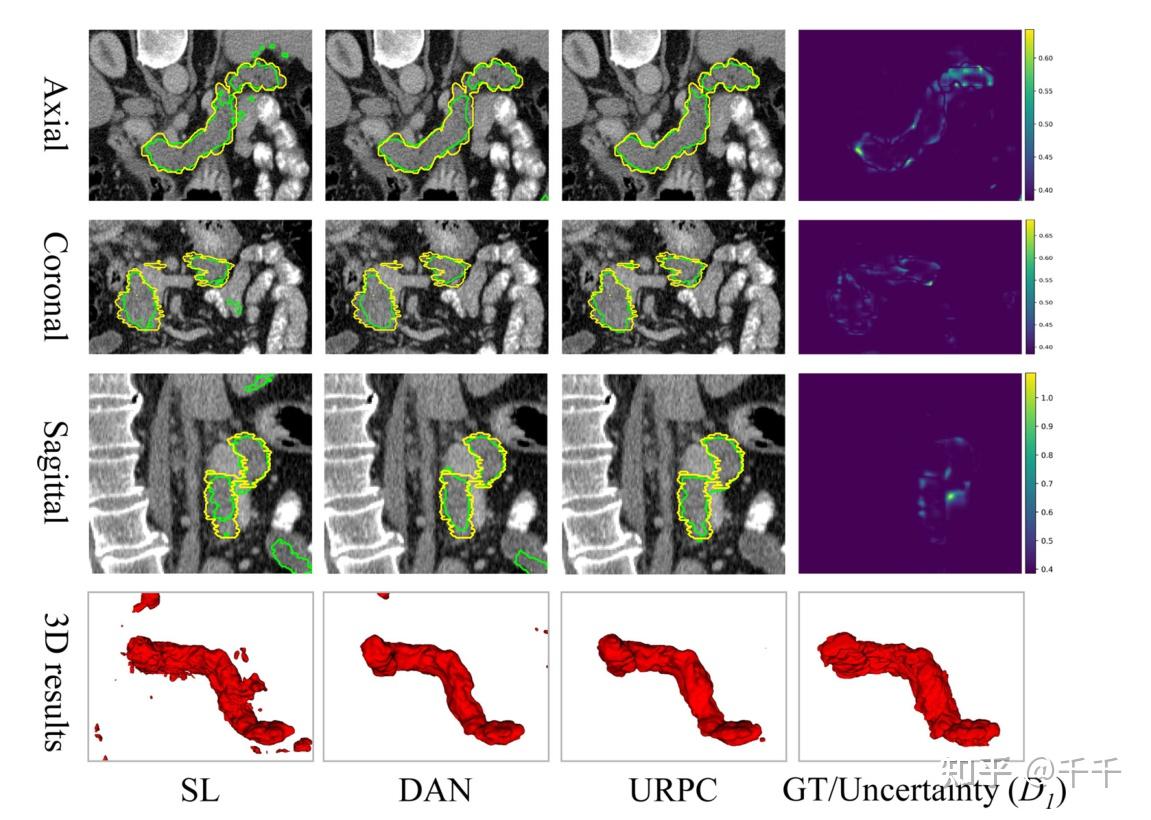 Semi-supervise d me dical image segmentation via uncertainty rectified ...