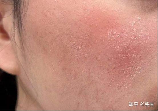 春季护肤重点,如何预防和缓解皮肤过敏? 知乎