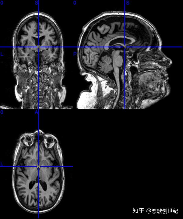基于SPM的磁共振图像(MRI)手动ACPC矫正 - 知乎