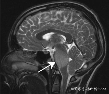 脑干胶质瘤DIPG都有哪些治疗进展？世界知名小儿神外Rutka教授论述 - 知乎