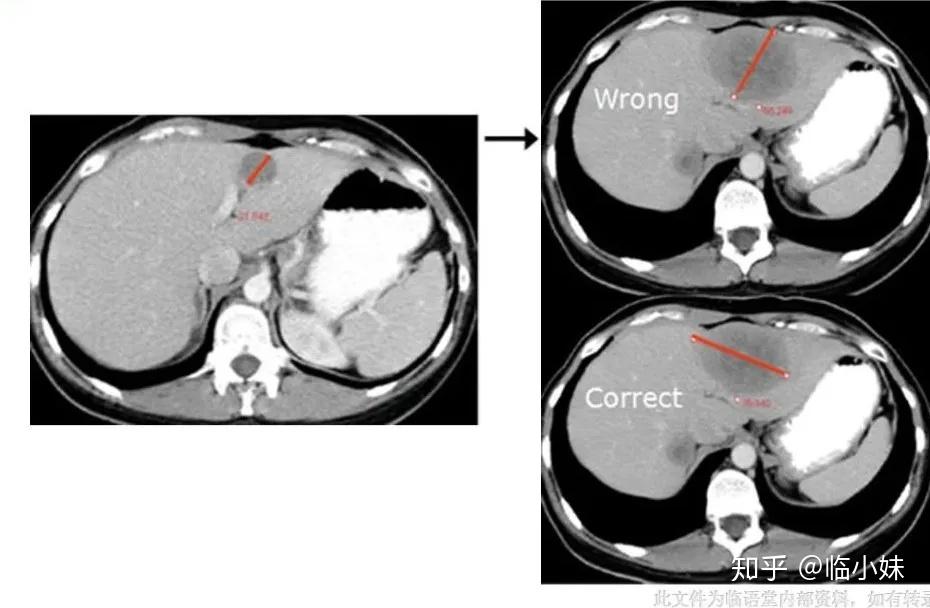 收藏 | 肿瘤临床试验（下）RECIST评估 - 知乎