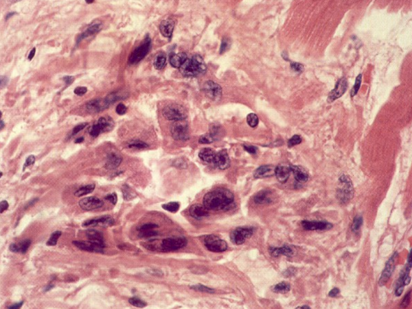 循环病理学：风湿病、风湿性心脏病、风湿性瓣膜病 - 知乎