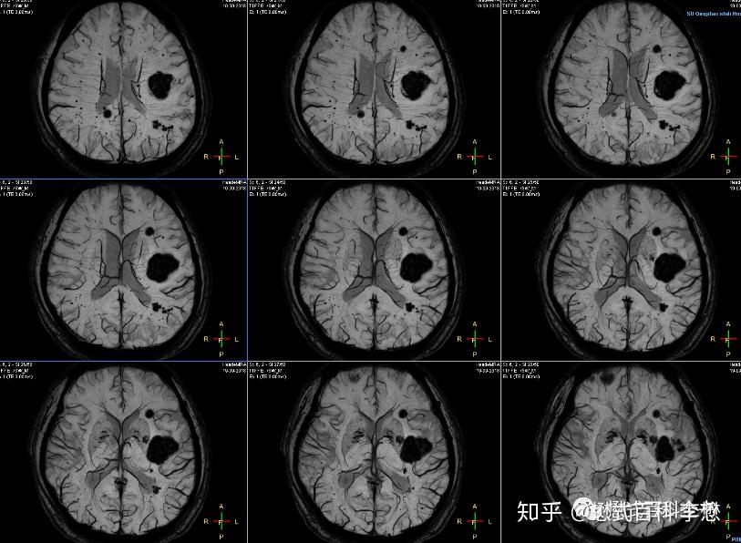 SWI序列原理及临床应用 - 知乎