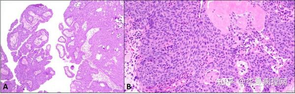 小活检，大学问-鼻腔鼻窦病种诊断要点（一） - 知乎
