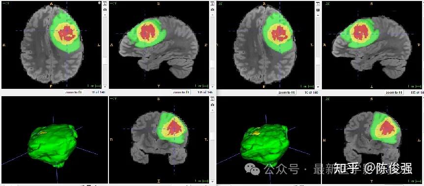 FeTS2024——2024联邦学习肿瘤分割 - 知乎