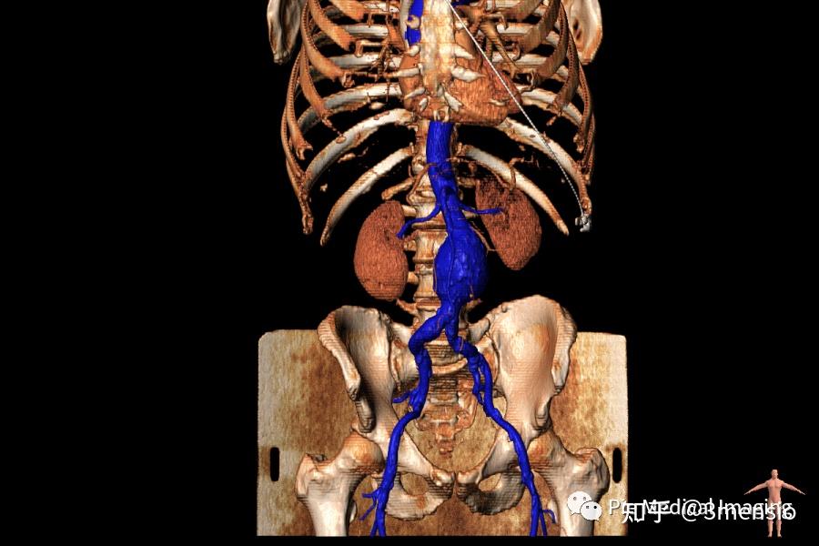 3mensio vascular - 知乎