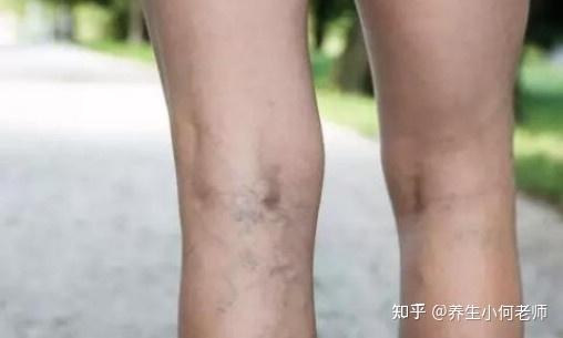 百病不出气血、瘀血、气滞血瘀,这样艾灸会比同龄人更显年轻 知乎