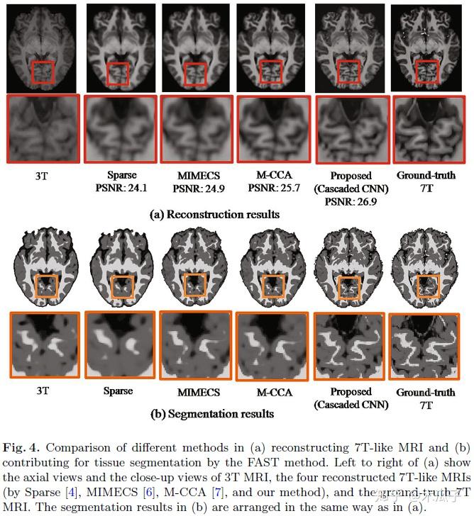 医学图像MRI增强相关论文 - 知乎