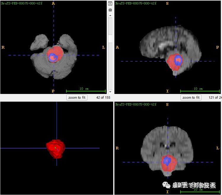 BraTS2023-PED——BraTS2023儿科肿瘤分割挑战赛 - 知乎
