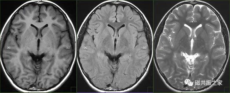 看一幅MRI图像好与不好的几个指标！ - 知乎