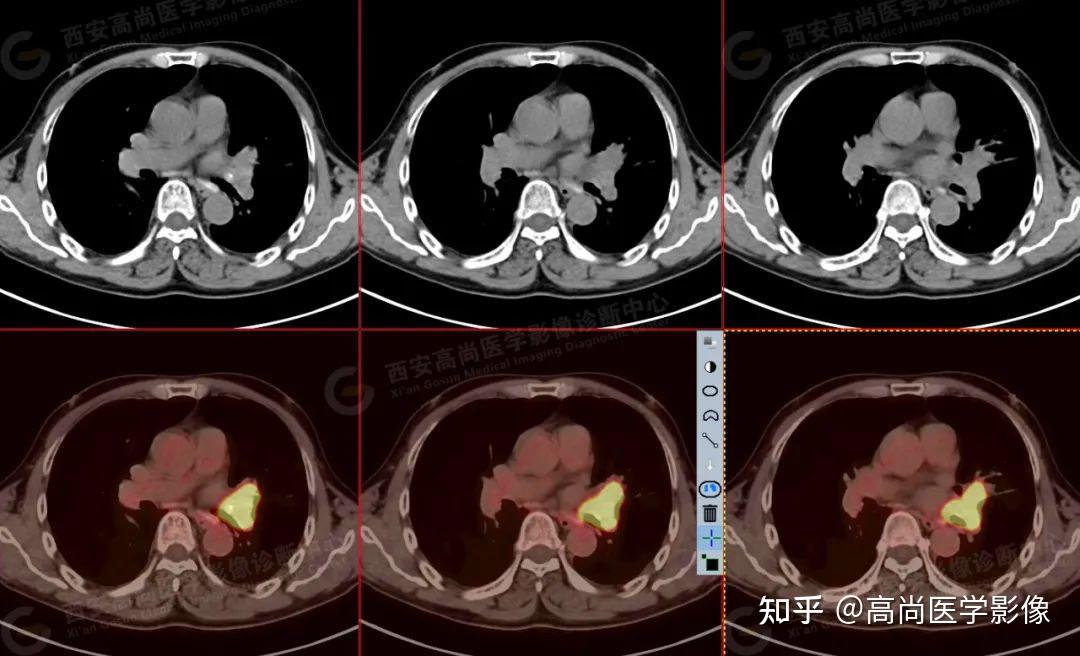 PET/CT病例：肺鳞癌5例【高尚医学影像】 - 知乎