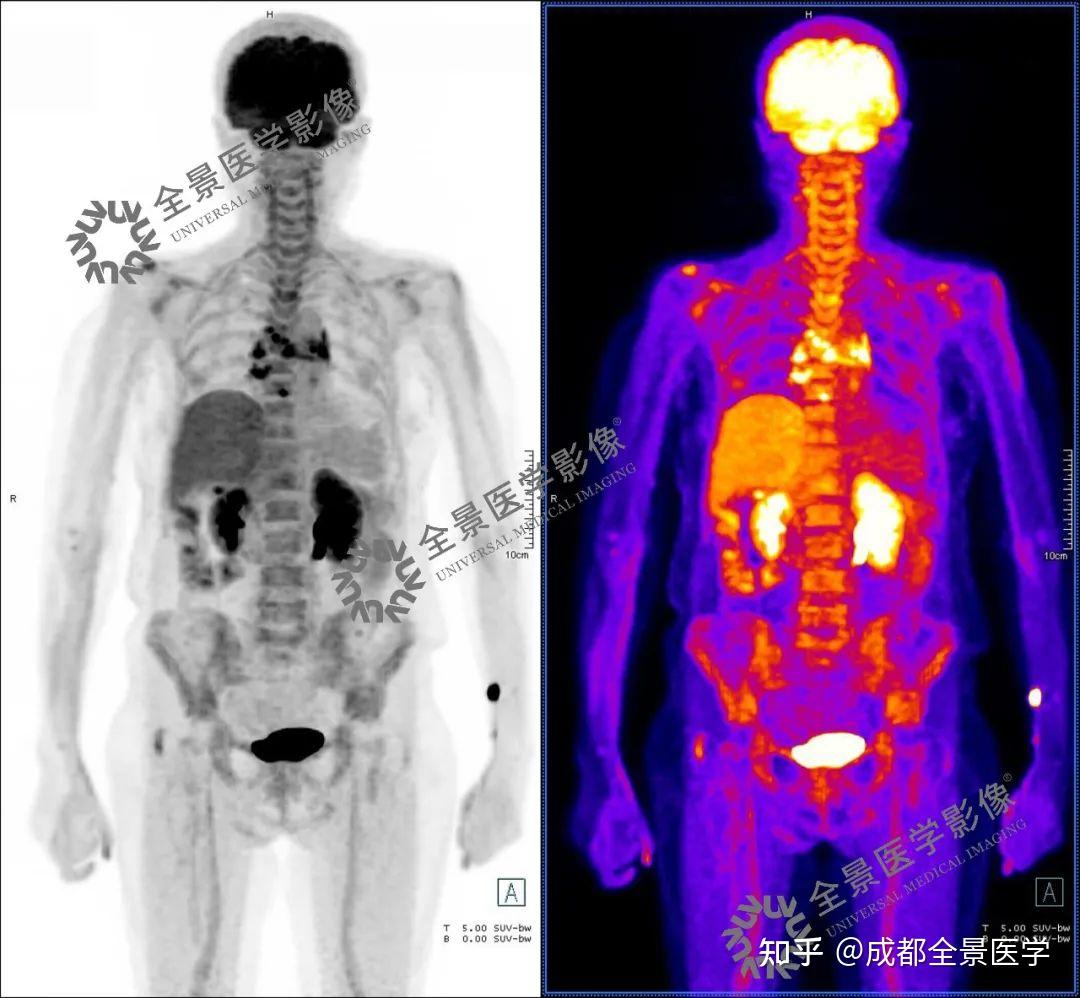 肝门占位难定性，PET/CT-MR揪出两个癌！ - 知乎