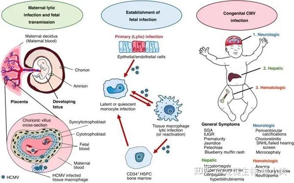 《Nature》前沿：HCMV与cCMV病毒感染与先天性疾病的关联 - 知乎